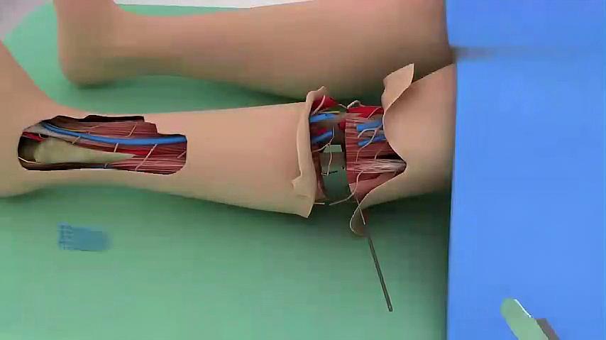 3D演示截肢手术,看完之后更关心残疾人了,看着都害怕