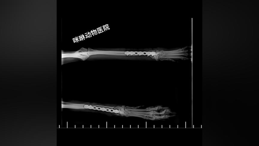 双侧尺桡骨骨折,都已做了双侧内固定手术
