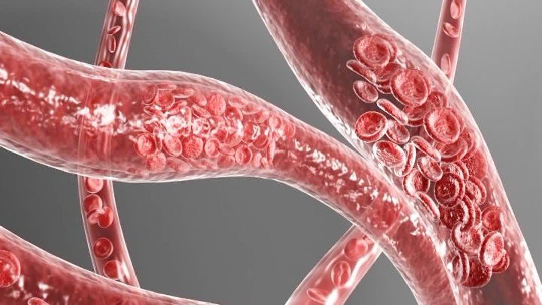 担心血管堵塞?牢记"3个字",清血管、防血栓,大病不上门!