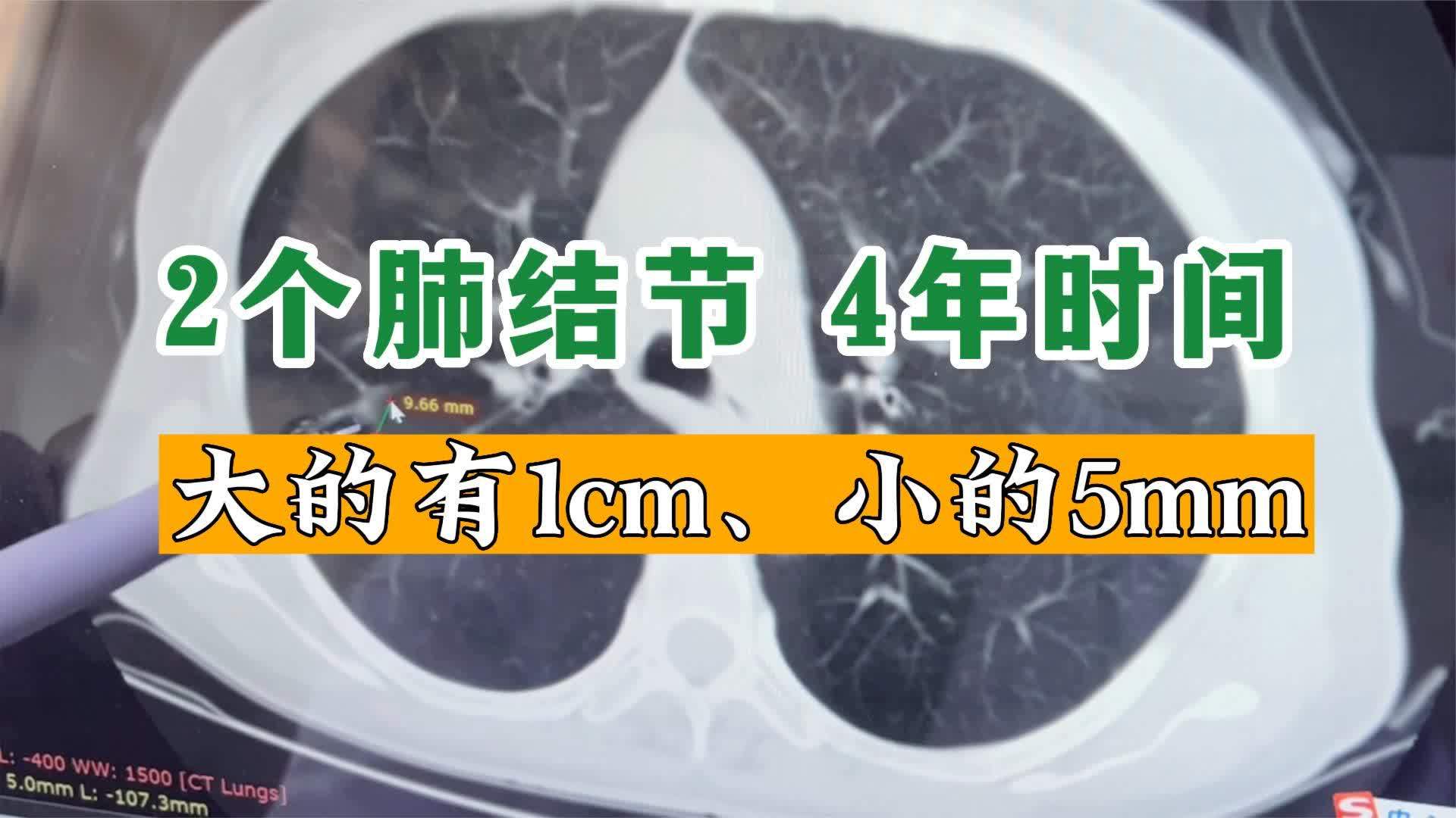 右肺2个结节,大的1cm、小的5mm,4年不变要处理吗?