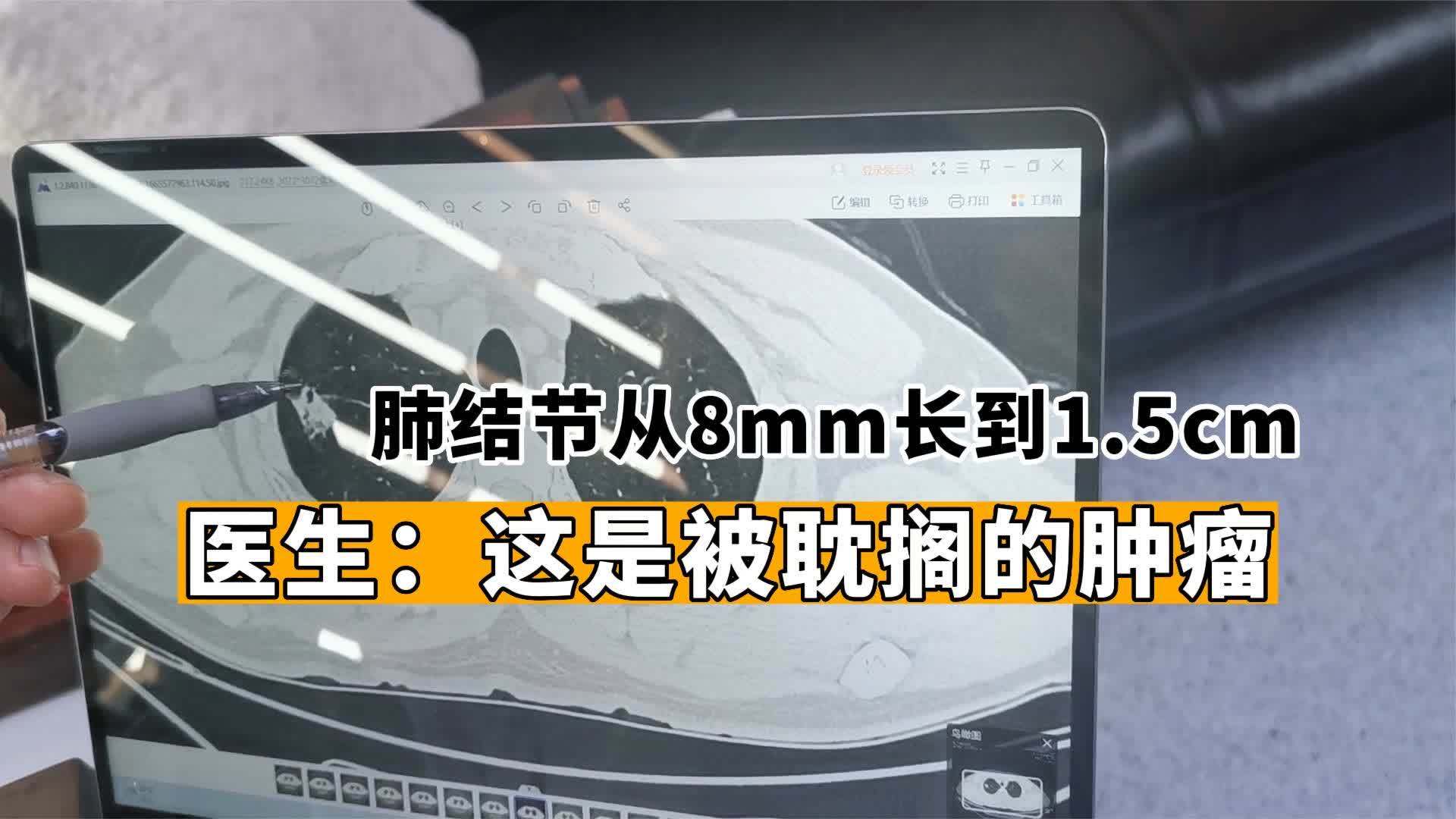1年时间肺结节从8mm长到1.5cm!医生直言:这是被耽搁的早期肿瘤