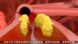 会加速血管堵塞的3种习惯,再不改正,小心血栓动脉硬化找上你