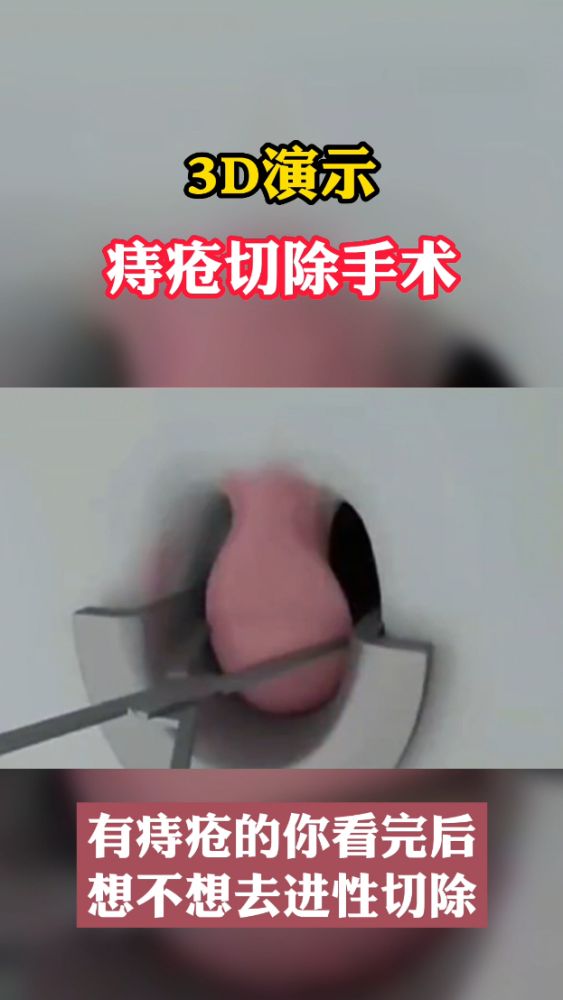 3D演示痔疮切除手术