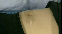 艾灸治疗 艾灸棒使用 艾灸盒使用视频