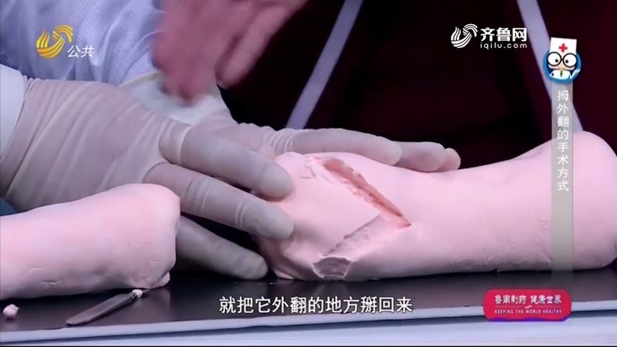 拇外翻严重的患者手术,需要截骨?来看看医生怎么说|身体健康