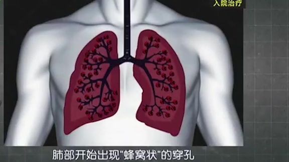 新冠肺炎病毒是怎样侵入人体细胞的,看完你就明白了!