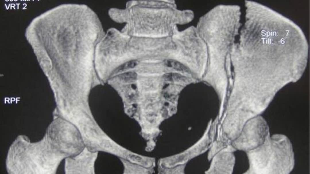 每日急救知识!骨盆骨折后,避免二次损伤,能做什么不能做什么?