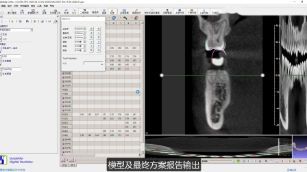 GuideMia 正畸培训 10-模型及最终方案报告输出.mp4