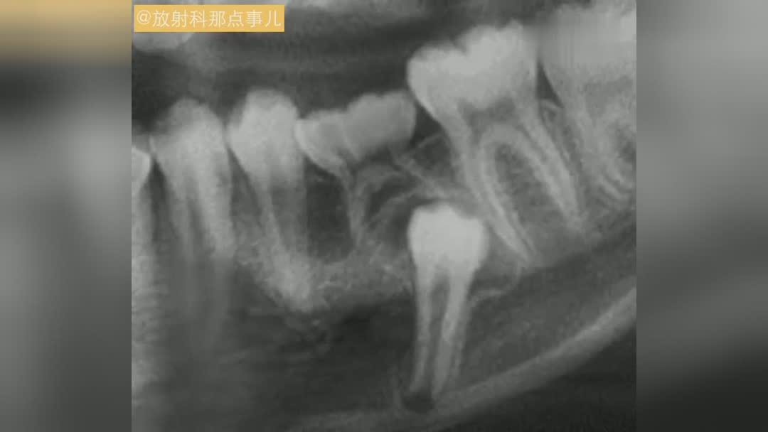X光片动态记录第二前磨牙正畸过程,效果非常明显,真的很神奇