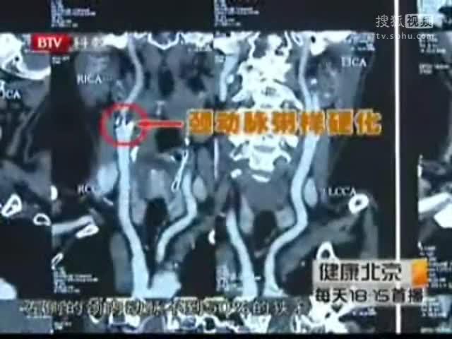 何教授养生堂,颈动脉斑块的危害