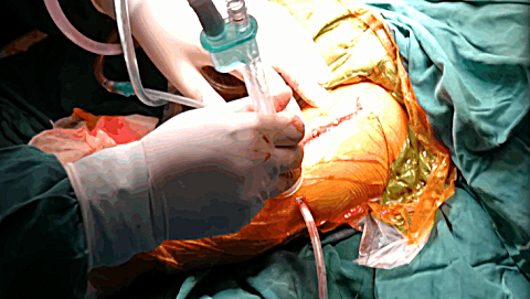 一次性脉冲冲洗器在手术室临床的使用视频