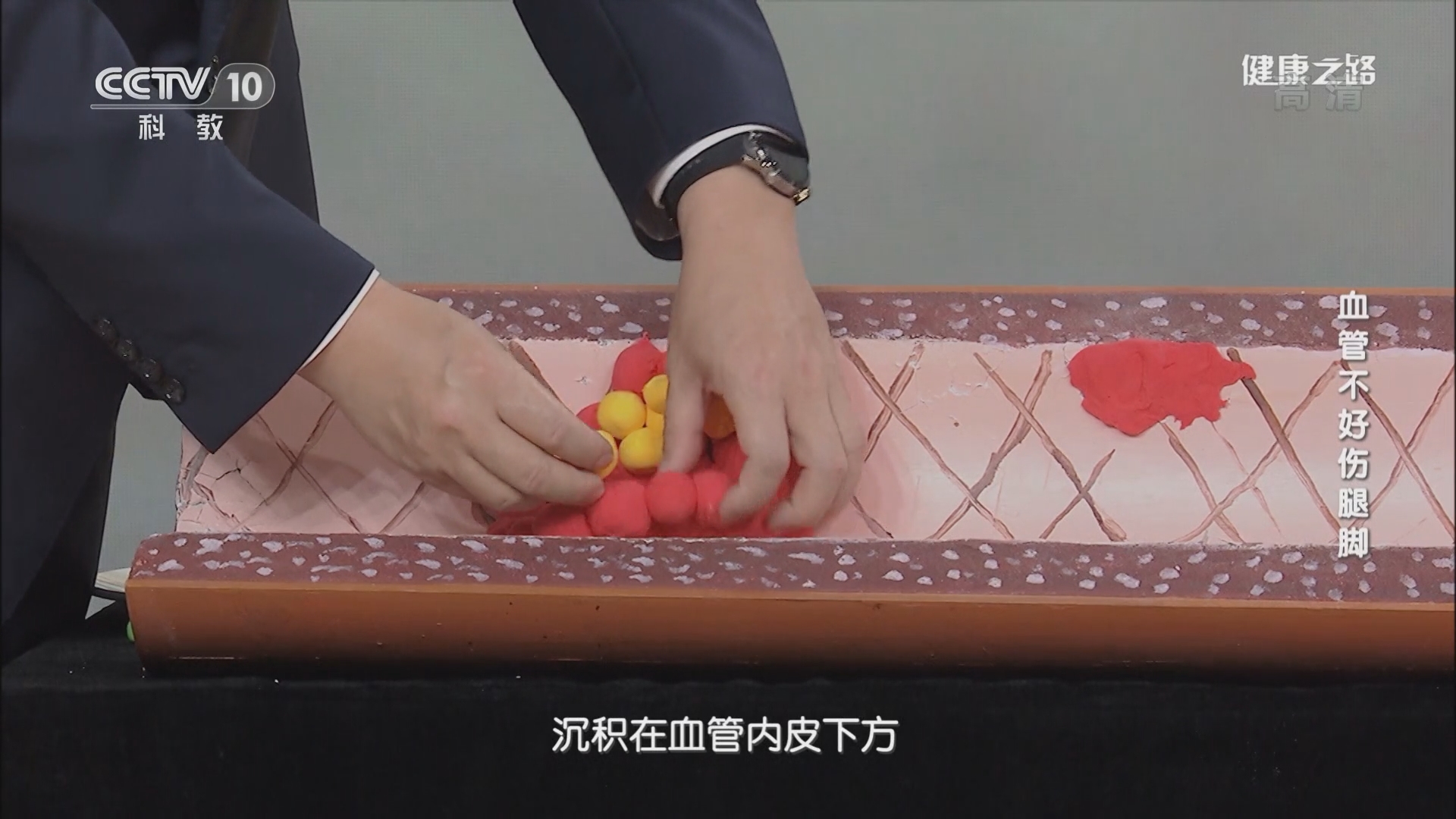 [健康之路]血管不好伤腿脚 下肢动脉硬化闭塞症的高危因素