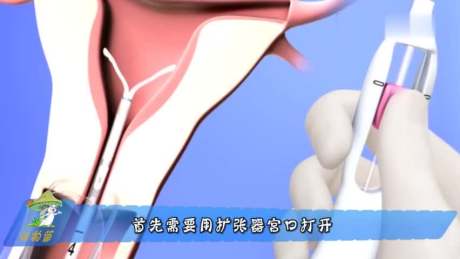 女性“上环”手术是怎样完成的,镜头拍下全程,看完令人心疼