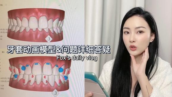 VLOG 牙套动画模型&正畸7个问题答疑感觉动画好神奇