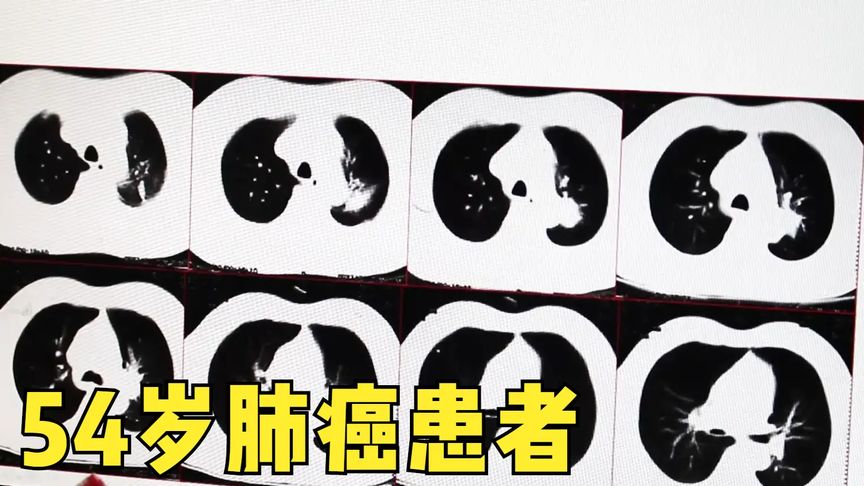 54岁肺癌患者,口服药物无效,两次治疗,消融肿瘤