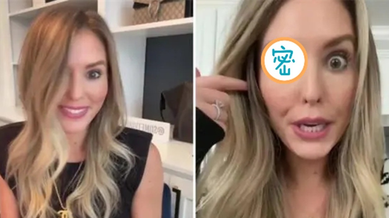 美女网红注射肉毒杆菌素后变阴阳脸 与之前判...