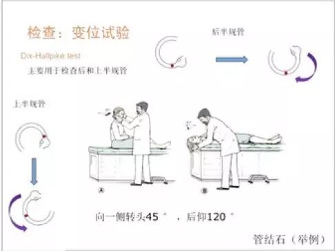 20160224-良性阵发性位置性眩晕的诊断和治疗