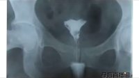 输卵管堵塞有什么症状吗?