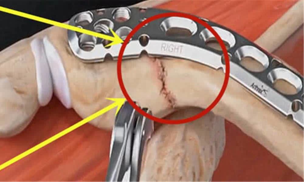 骨折究竟有多疼?3D动画模拟骨折修复手术,隔着屏幕都觉得疼