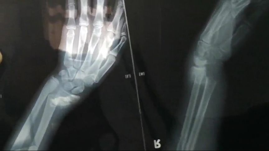 张立群中医正骨小夹板外固定治疗尺桡骨骨折