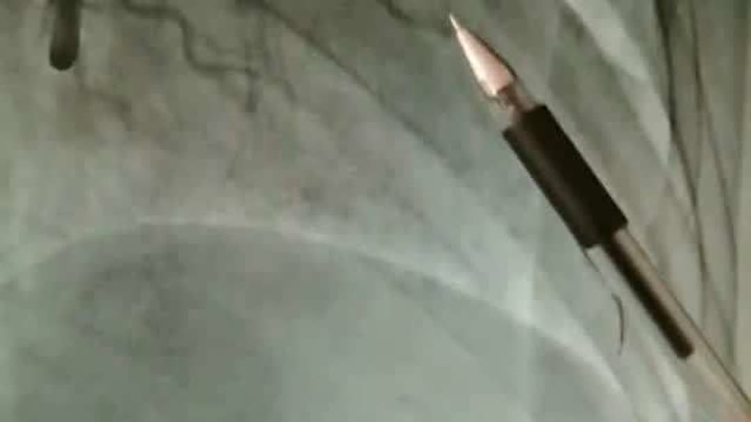 心肌梗死的冠脉造影是怎样的,支架是如何放进去的?