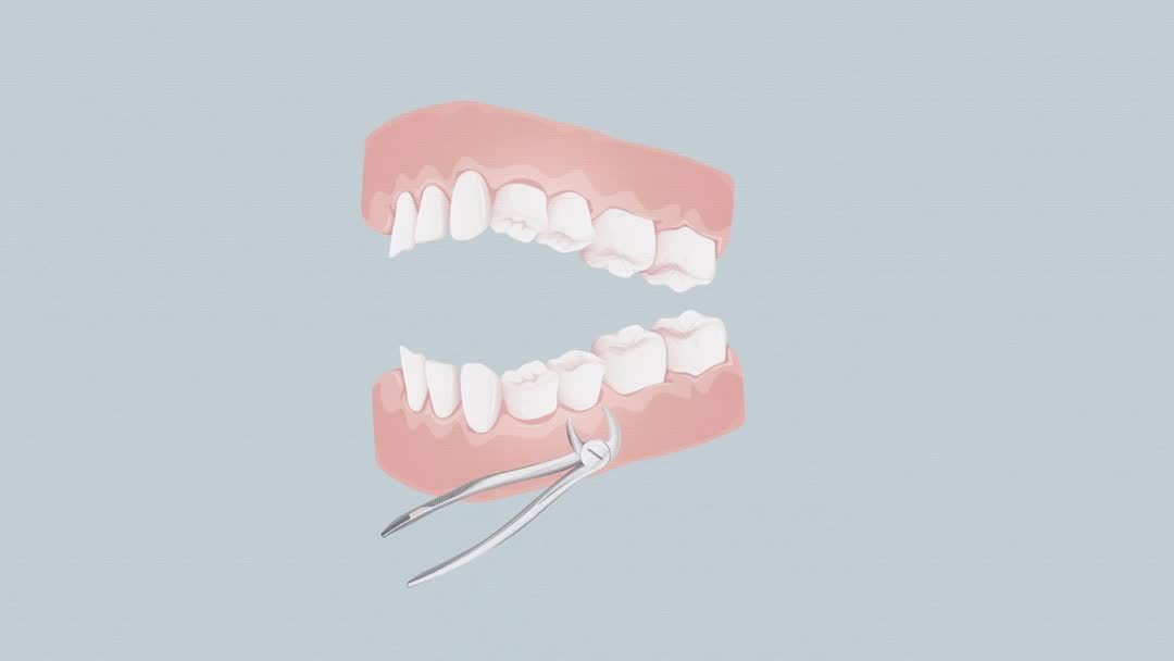 牙是怎样种植上去的?这三步即为种植牙的全过程
