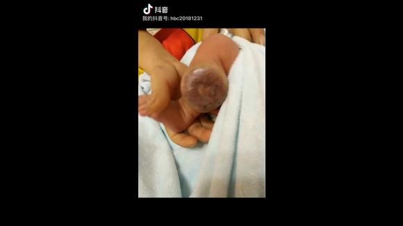 婴幼儿血管瘤治疗康复图片