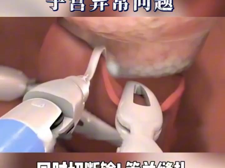宫腔镜3D手术全过程