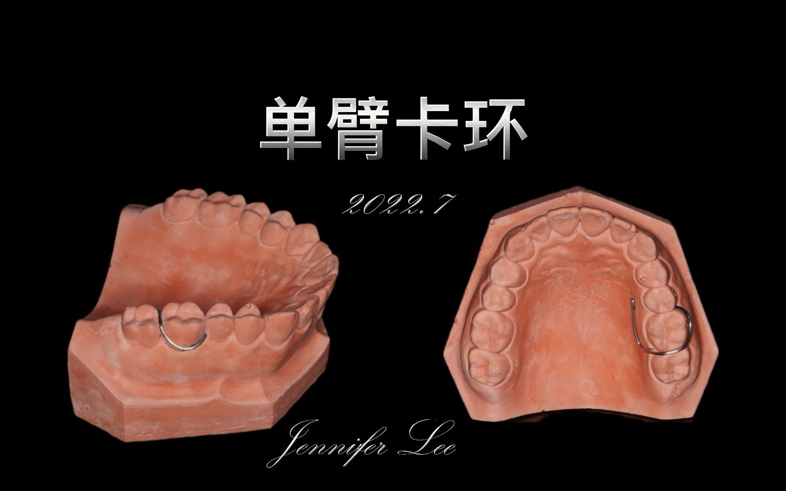 单臂卡环-口腔正畸弓丝弯制
