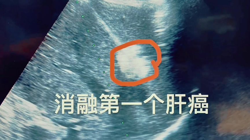 传统微波消融针粗大,消融范围大对残余肝功能影响大