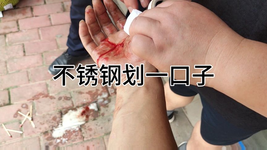 今天上班不小心出现意外,被不锈钢咬一口,一定安全生产