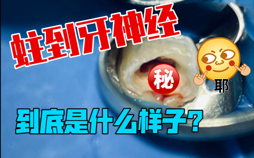 【根管治疗】通往牙神经的路,有亿点点酸爽!