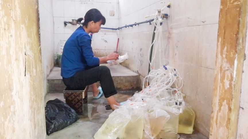 40岁尿毒症晚期,每天透析四次每次两公斤,余生就靠这些袋子活命