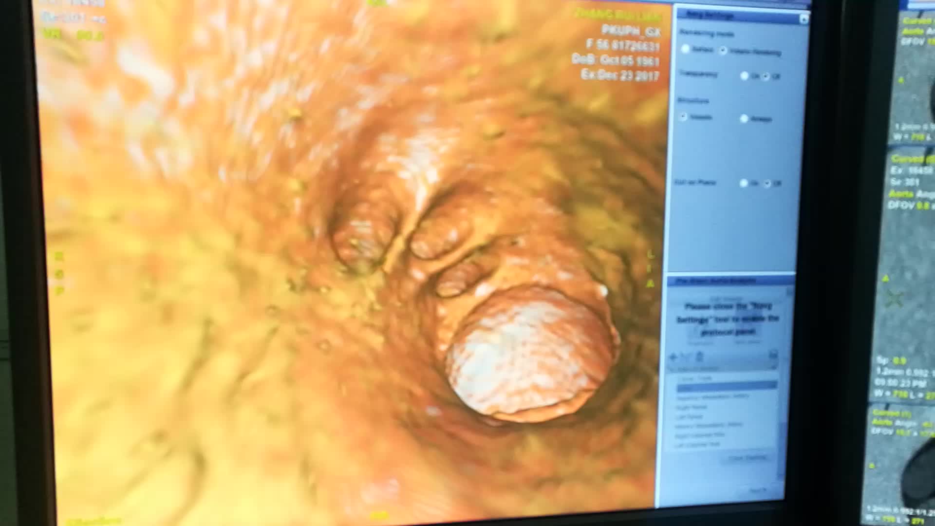 根据CT影像做出来的模拟血管镜影像,就像人在血管里走看,到各个分支...