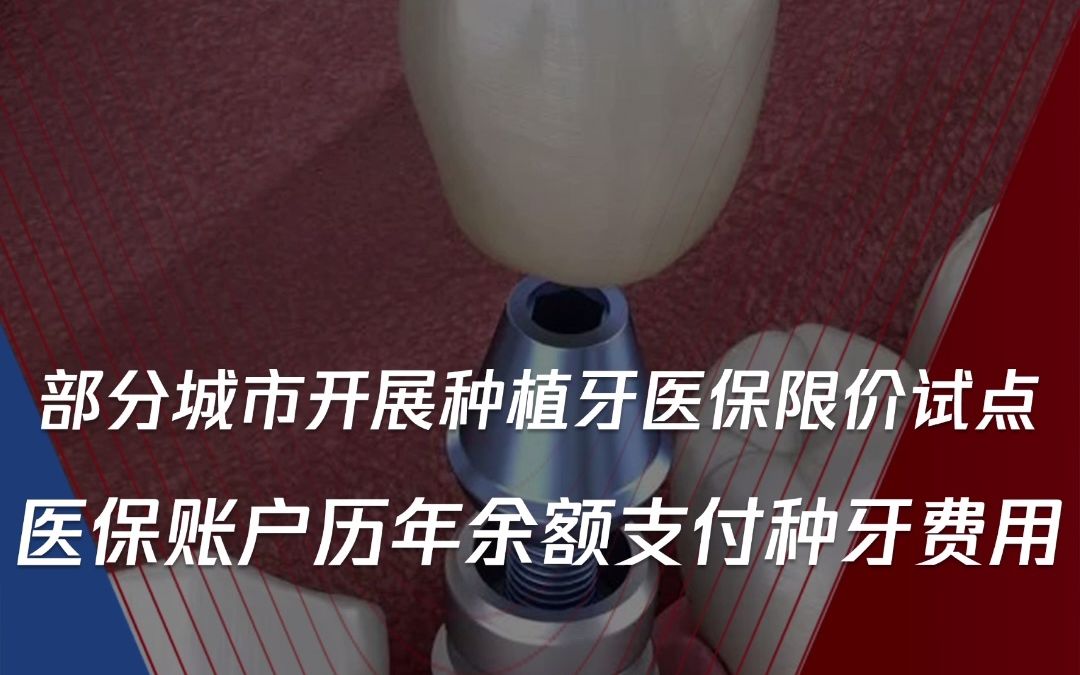 部分城市开展种植牙医保限价试点,可用医保账户历年余额支付种牙费用