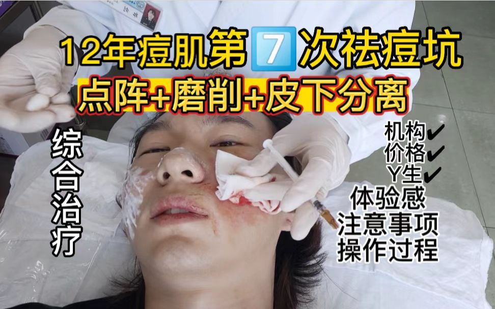 综合祛痘坑Co2点阵激光+皮下分离+磨削 12年痘肌第7️⃣次治疗痘坑