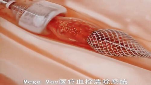 国外发明的血栓清除技术,动画展现清除过程,希望可以帮助更多人!