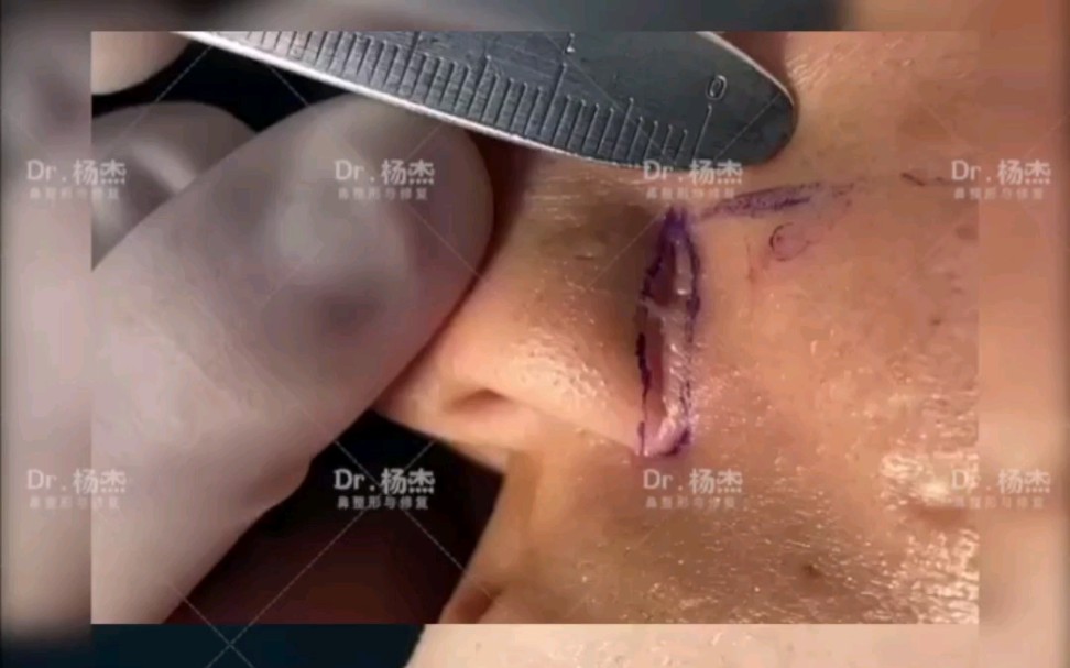 分享一个鼻翼缩小疤痕修复切除,完整切除疤痕组织