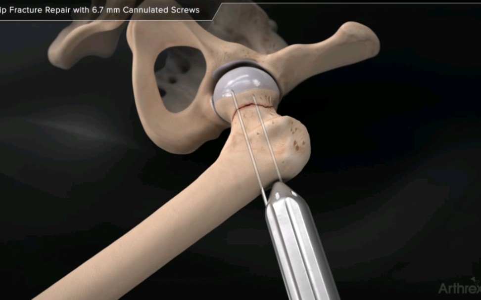 大腿股骨颈骨折手术修复过程,3D演示。