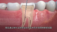 根管治疗, 摆脱牙痛, 还能保住牙齿