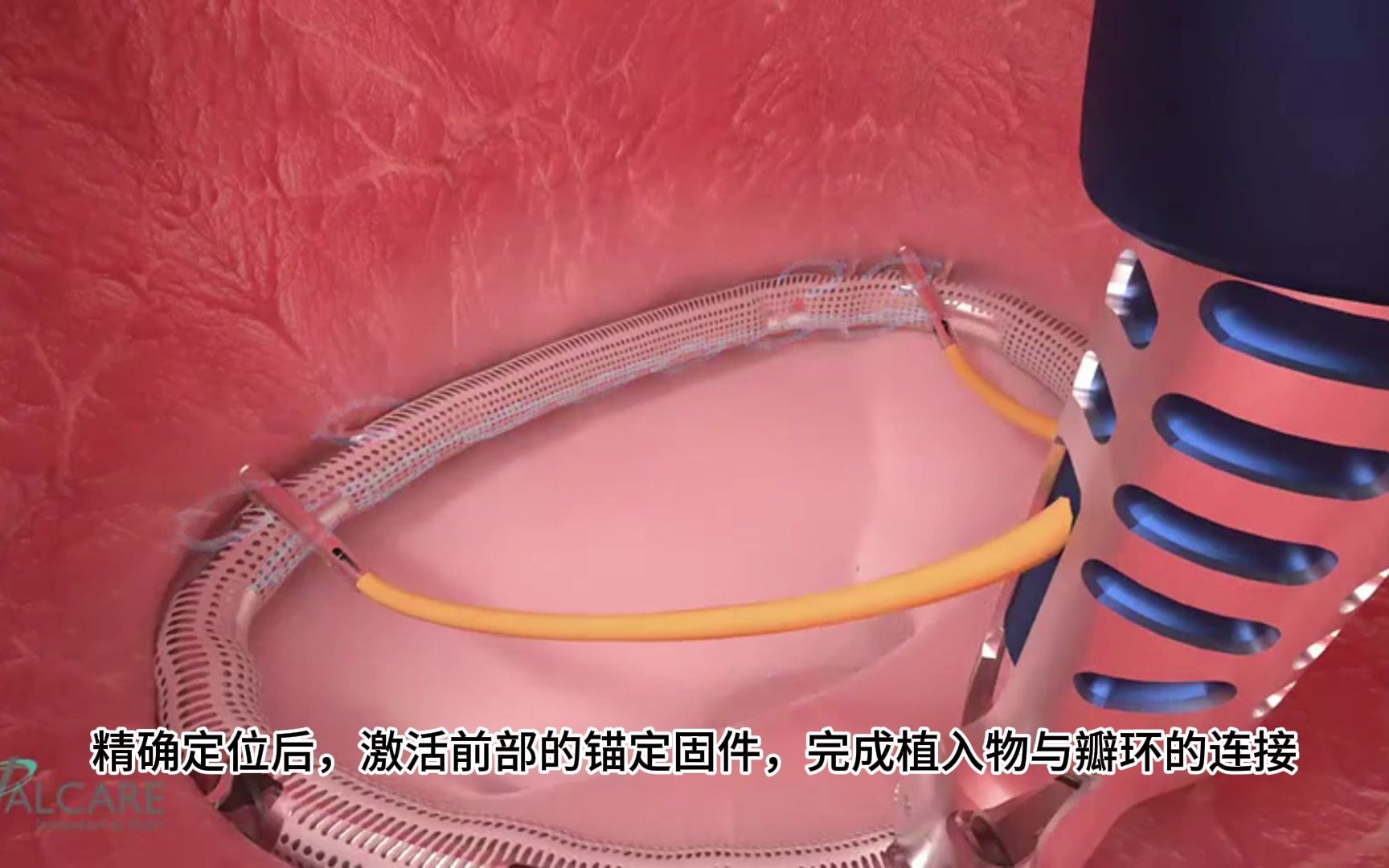 [医学科普]功能性二尖瓣反流的经导管瓣环成形术系统Amend(已添中文...