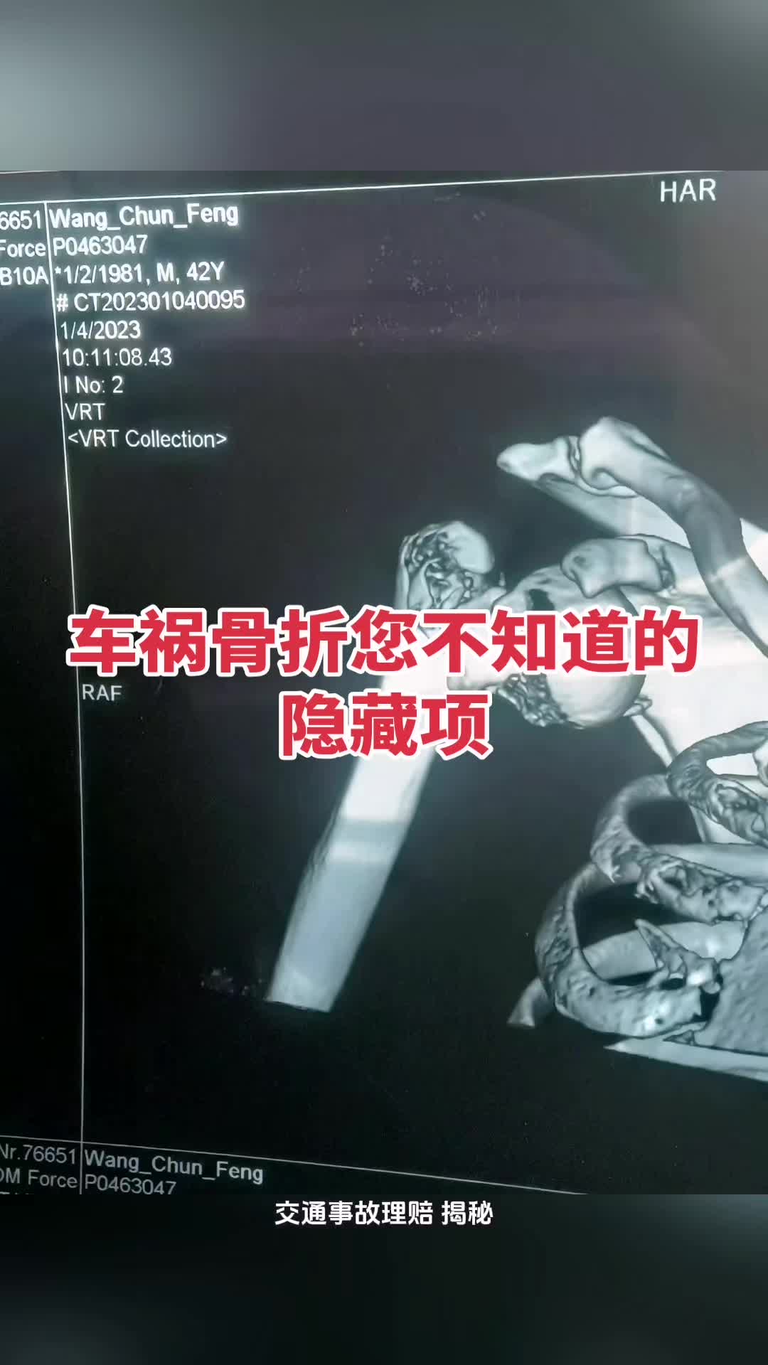 车祸骨折赔偿,您不知道的隐藏项 #车祸赔偿 #交通事故赔偿 #交通事故...