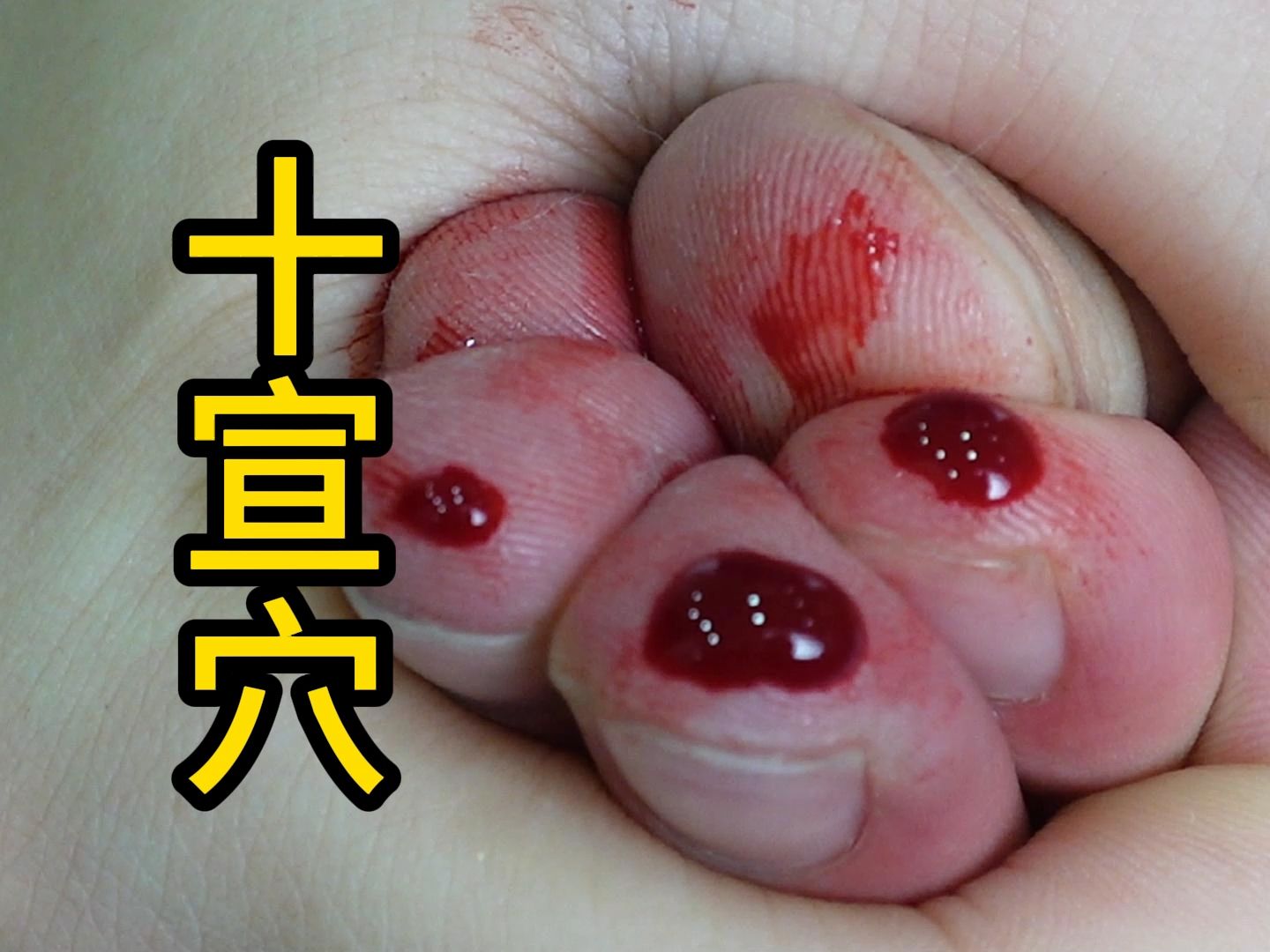 十宣穴~中医急救要方