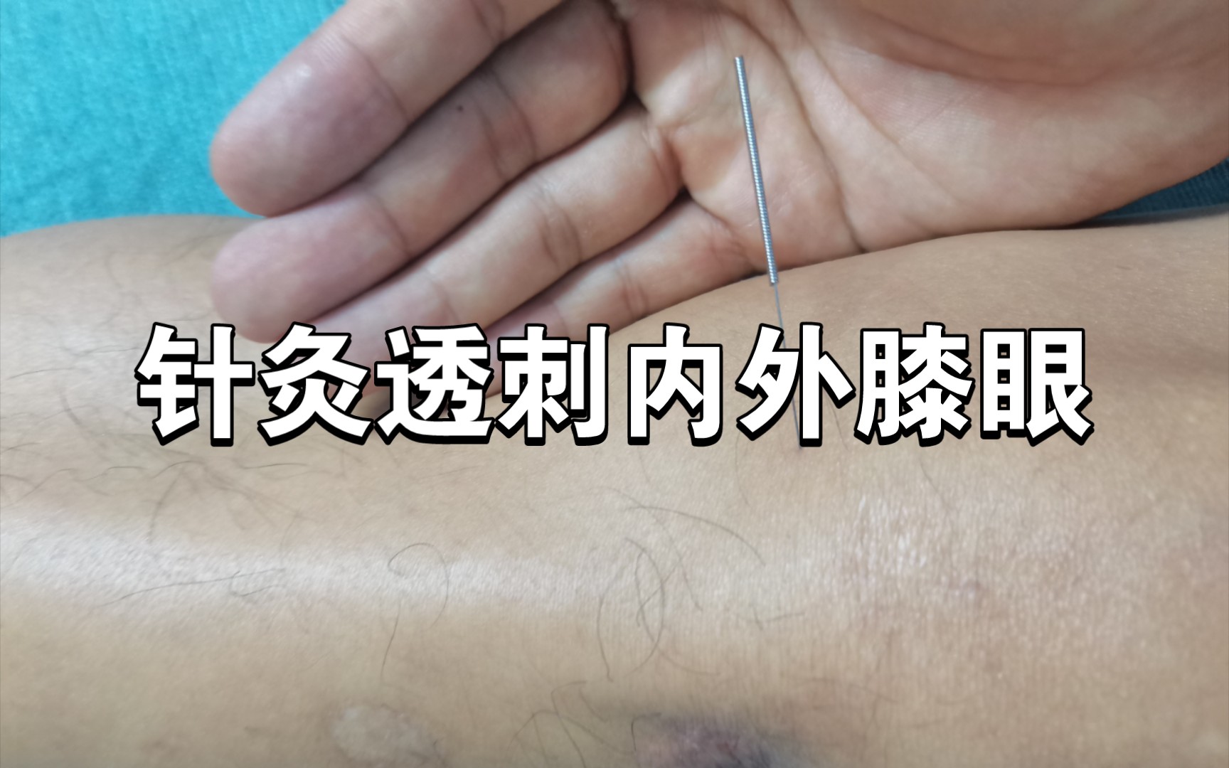 膝关节损伤针灸疗法,内外膝眼透刺!感觉良好!