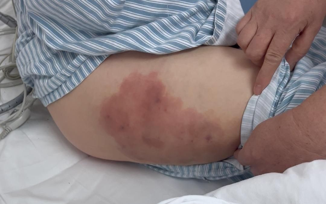 动脉畸形加毛细血管畸形