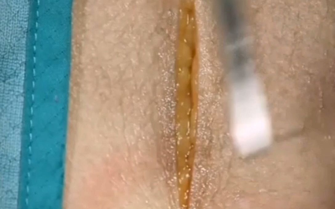 外科医生学习系列—连续锁边缝合