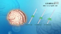 医疗器械三维动画--软组织扩张器