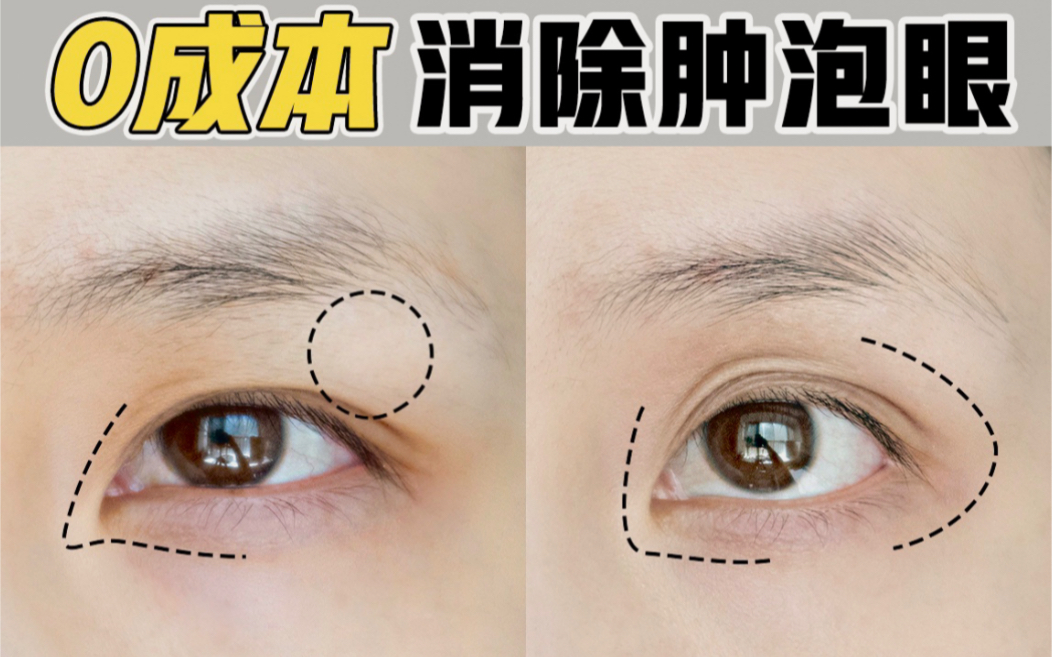 【summer】干货!每天三分钟0成本消除肿眼泡!外网火爆亲测有效