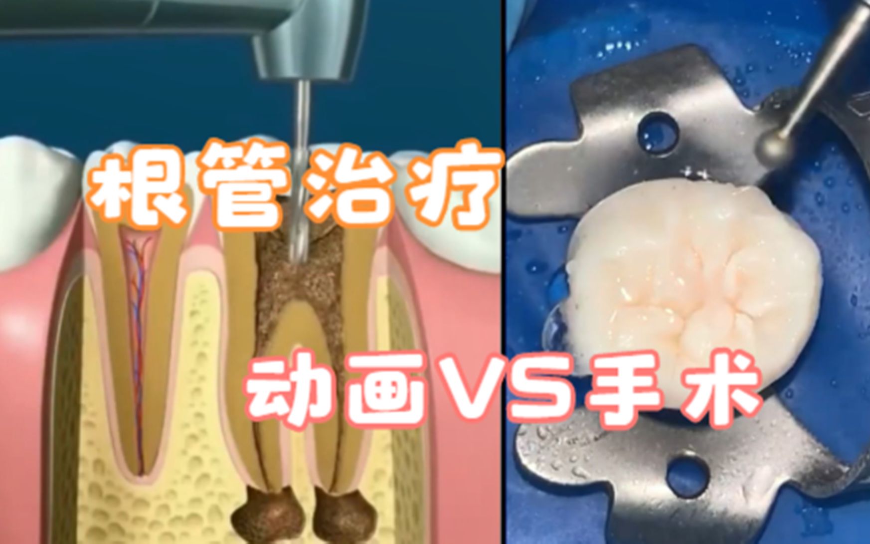 牙齿根管治疗手术视频,牙髓炎根尖周炎牙周炎牙外伤等轻松搞定