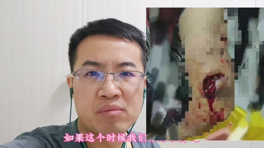 你有被狗咬过吗?最近又发生了几例被恶犬咬伤的患者